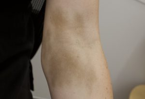 Iron Stains - Kingsway Dermatology & Aesthetics (KDAA)